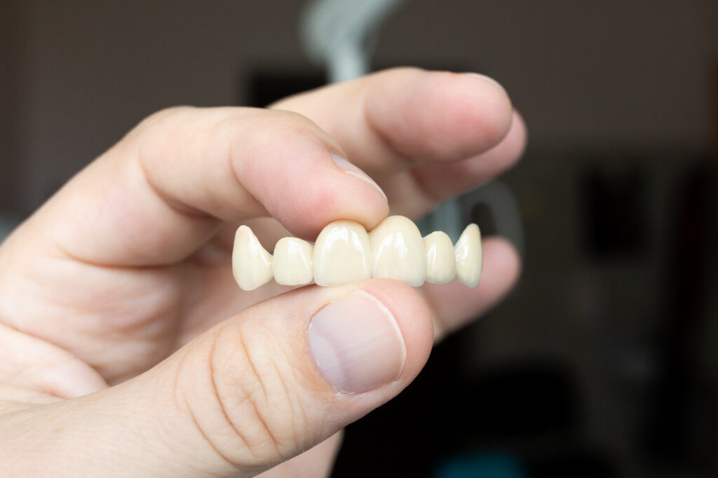 Vaste brug op implantaten – CDCtandzorg